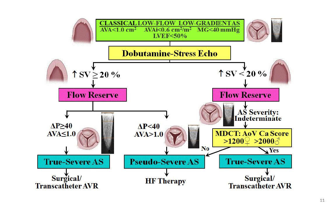 Prof. Dr. Alp Aydınalp / Aortic stenosis and low flow state ...