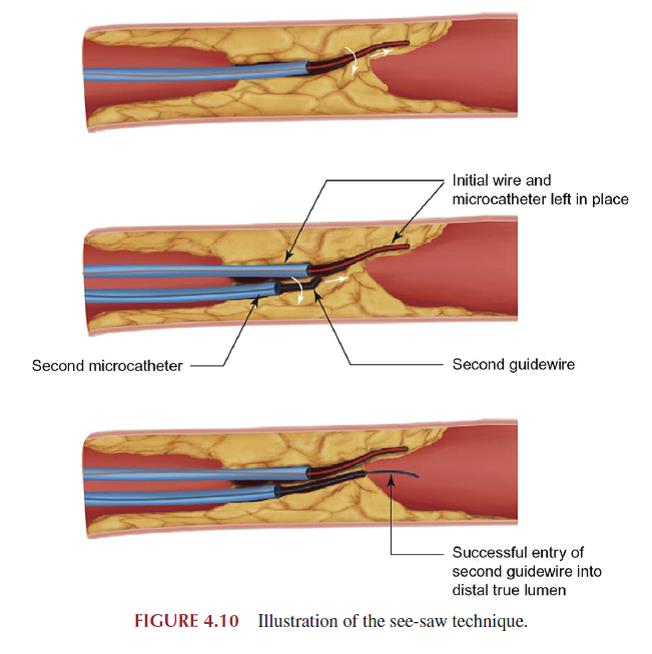 Prof. Dr. Alp Aydınalp / Kronik Total Oklüzyon Antegrad Yaklaşım