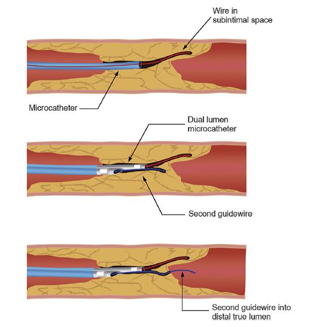 Prof. Dr. Alp Aydınalp / Kronik Total Oklüzyon Antegrad Yaklaşım