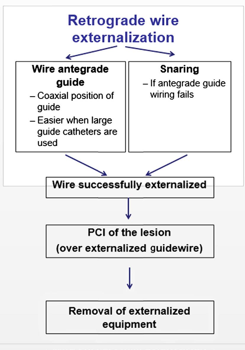 Guideliner Vs Guidezilla
