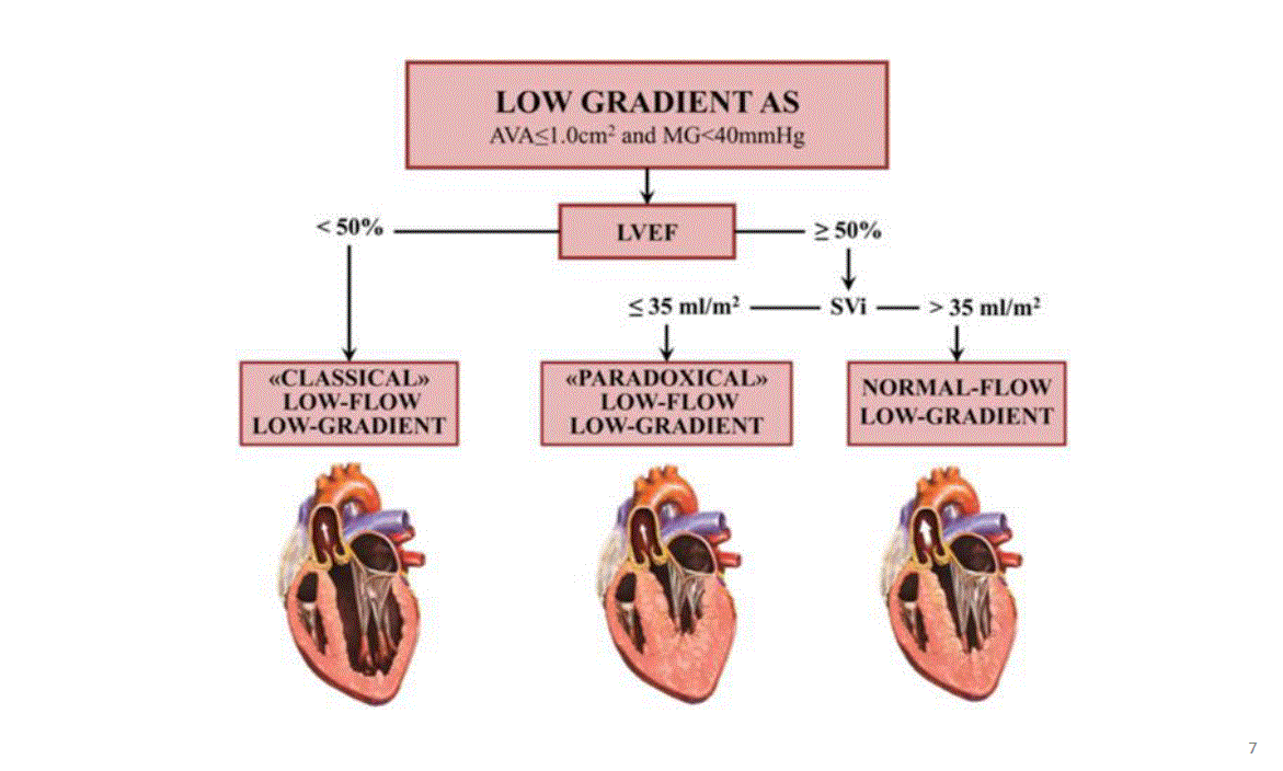 Prof. Dr. Alp Aydınalp / Aortic stenosis and low flow state ...