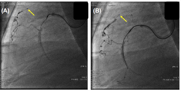 Prof. Dr. Alp Aydınalp / Kronik Total Oklüzyon Antegrad Yaklaşım